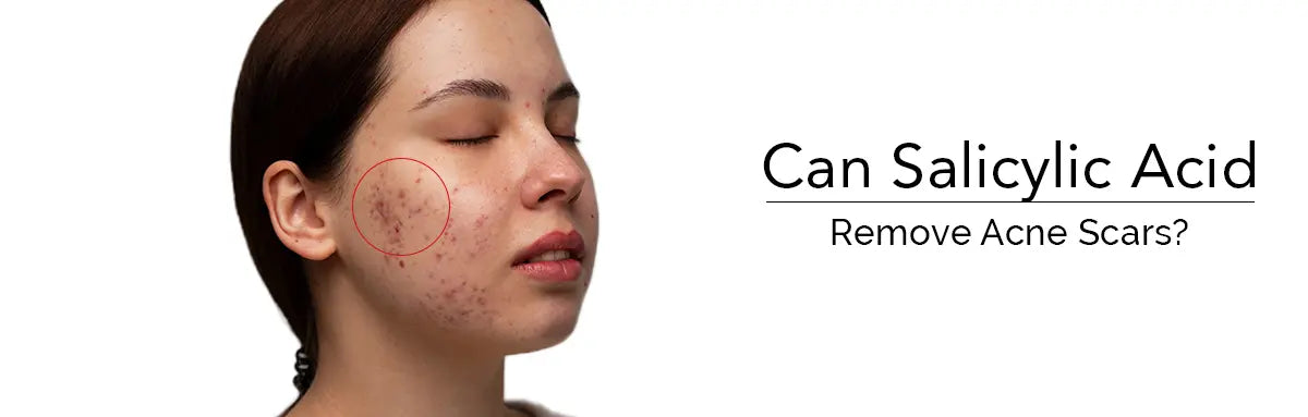 Does Salicylic Acid Remove Acne Scars? – Kass