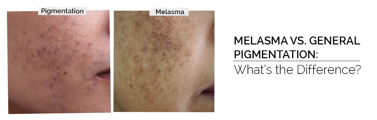Melasma vs. General Pigmentation: What’s the Difference? – Kass