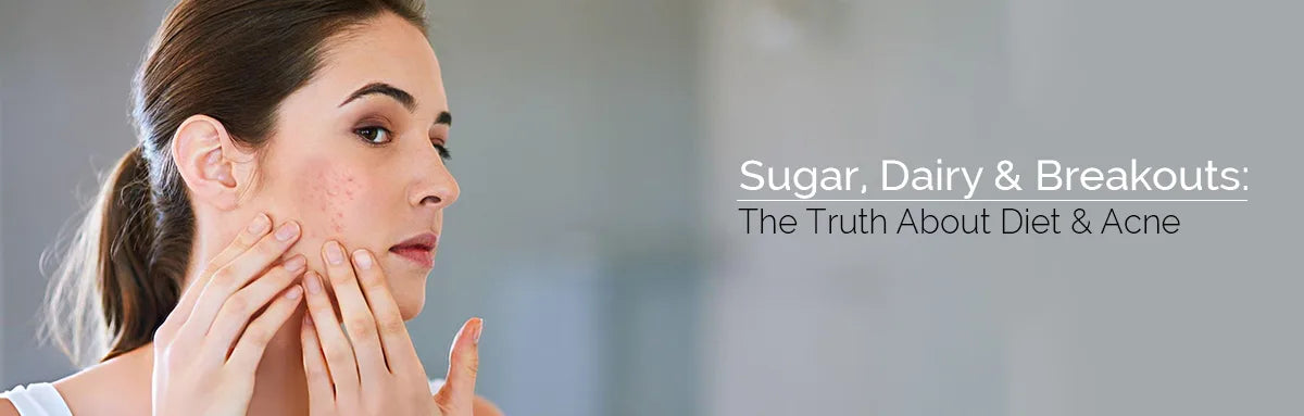 Sugar, Dairy & Breakouts: The Truth About Diet and Acne – Kass